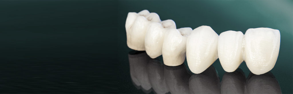 metal free crowns - Dentists in Chennai